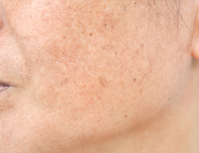 10 Best Melasma Creams in the Philippines 2026 l Buying Guide Reviewed ...