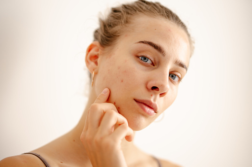 50 Best Skincare Products for Acne in the Philippines 2026 | mybest
